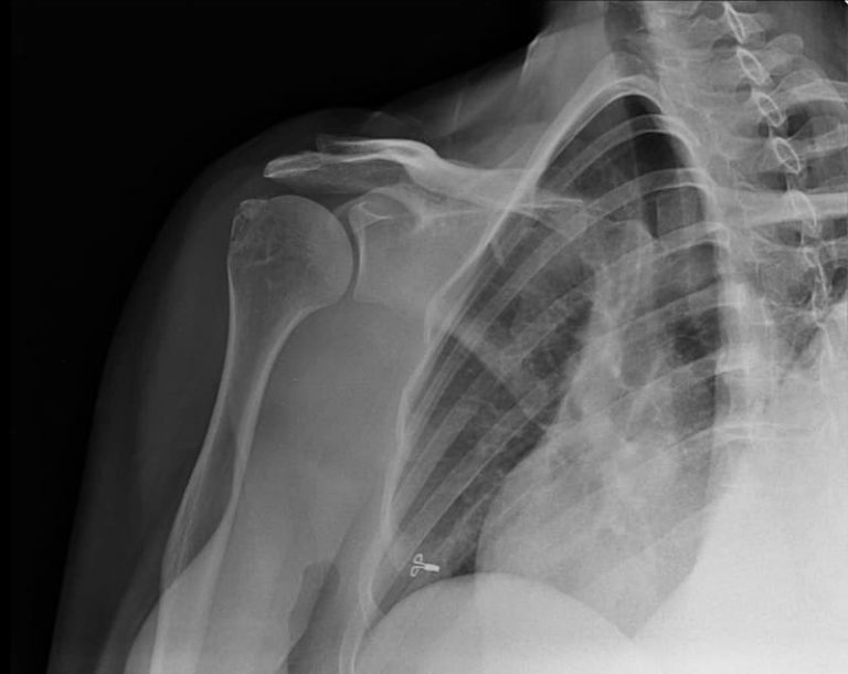 Fractura de Troquíter: Dolor, tratamiento y tiempo de recuperación | JL ...