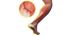 Rotura fibrilar en el gemelo: Tratamiento y tiempo de recuperación