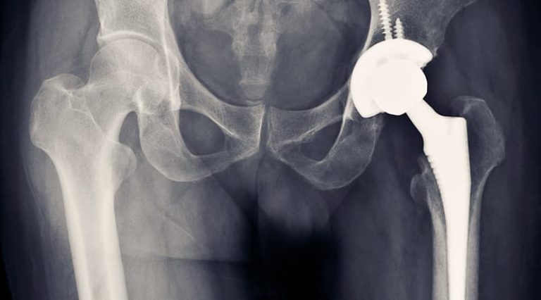 Dolor y molestias después de una operación de cadera | JL FISIOS
