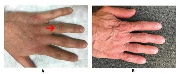 Capsulitis en los dedos: qué es, síntomas y tratamiento | JL FISIOS