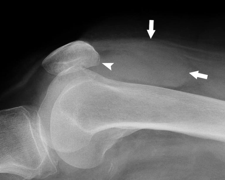 Rodilla inflamada y caliente: causas, señales de alarma y qué hacer| JL ...